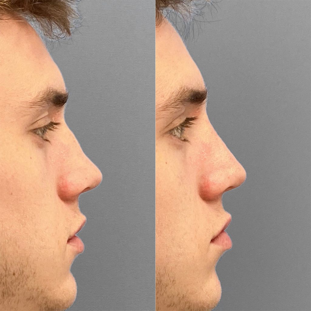 Non-Surgical Rhinoplasty Brisbane - Nose Fillers - Ascension