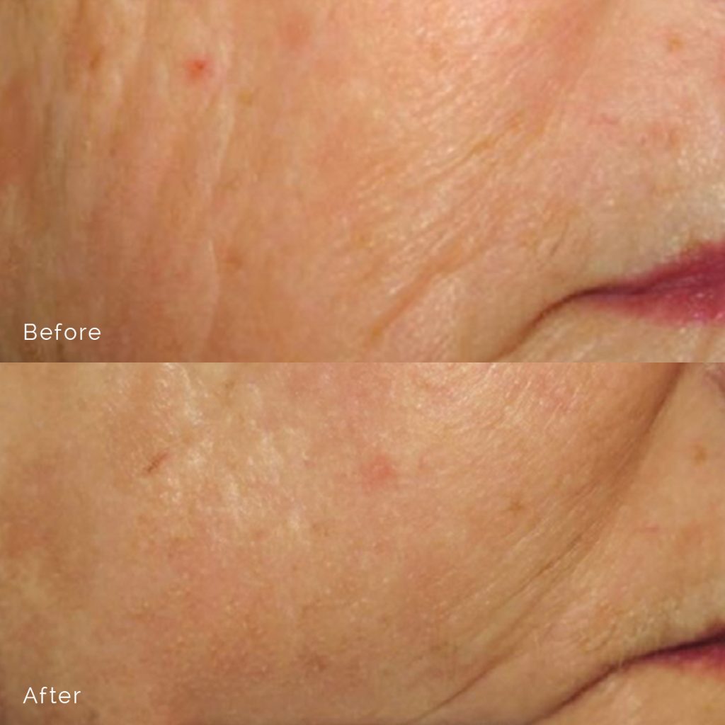PicoSure Pro Laser Brisbane - Ascension Cosmetic Medicine